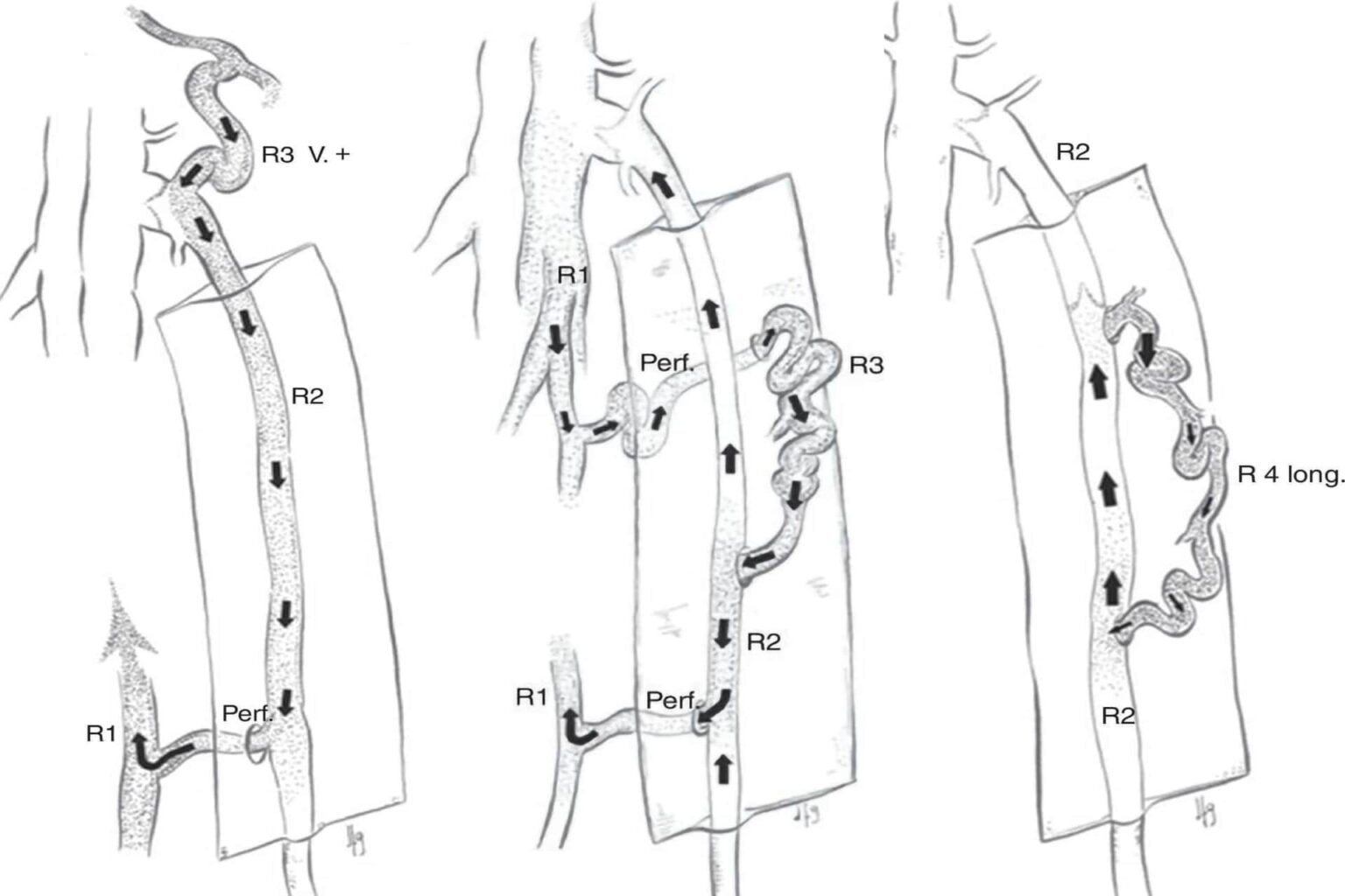 ¿Cual es el Mejor Tratamiento para las Varices?