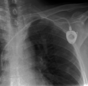 El cateter portacath - Blog de Varices Barcelona 🧑‍⚕️