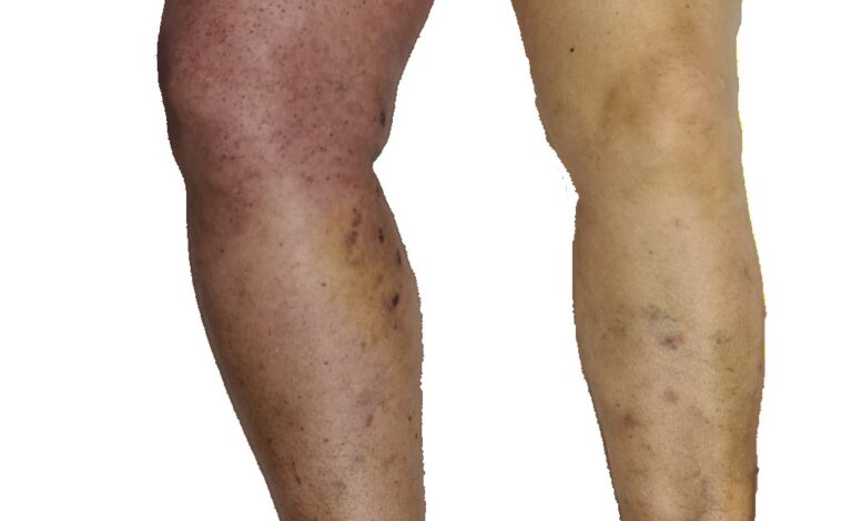 Edemas en las Piernas: Causas, Tratamientos y Consejos