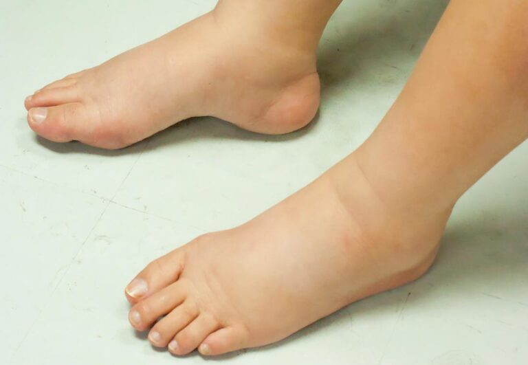 Edemas en las Piernas: Causas, Tratamientos y Consejos